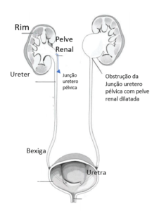 Estenose de JUP em adultos: muito tarde para tratar?