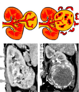 Angiomiolipoma: um guia completo sobre esse tumor renal