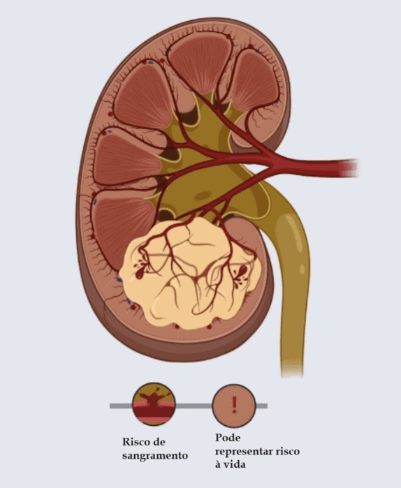 Angiomiolipoma: um guia completo sobre esse tumor renal